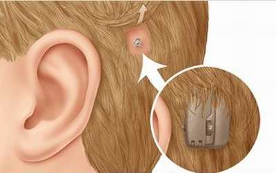 Implantes cocleares; Prótesis Coclear; Prótesis Auditiva